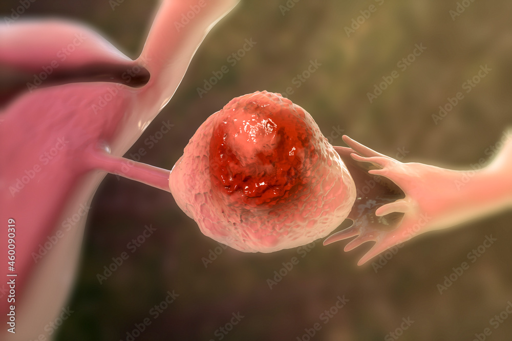 Ovarian cancer, 3D illustration Stock Illustration | Adobe Stock
