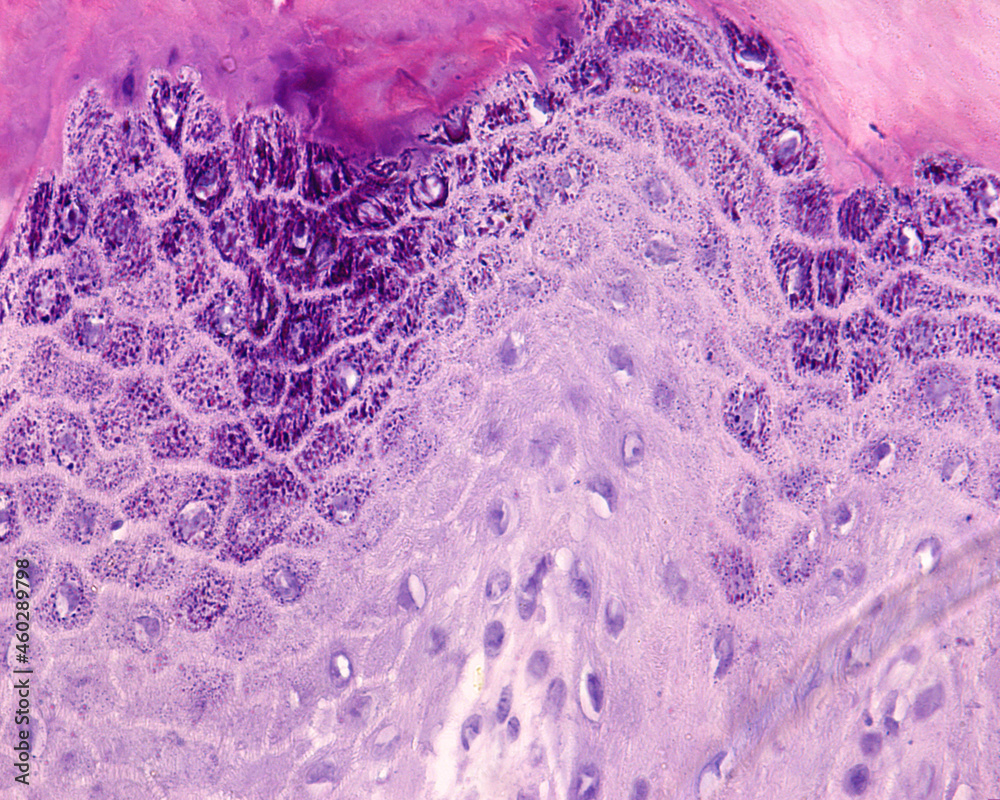 Plantar wart epidermis. Hypergranulosis. Hyperkeratosis Stock Photo ...