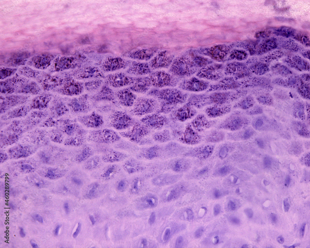 Plantar wart epidermis. Hypergranulosis. Hyperkeratosis ilustración de ...