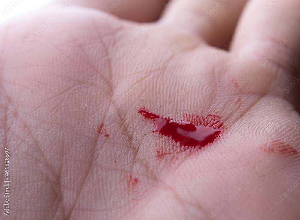 Hand Laceration