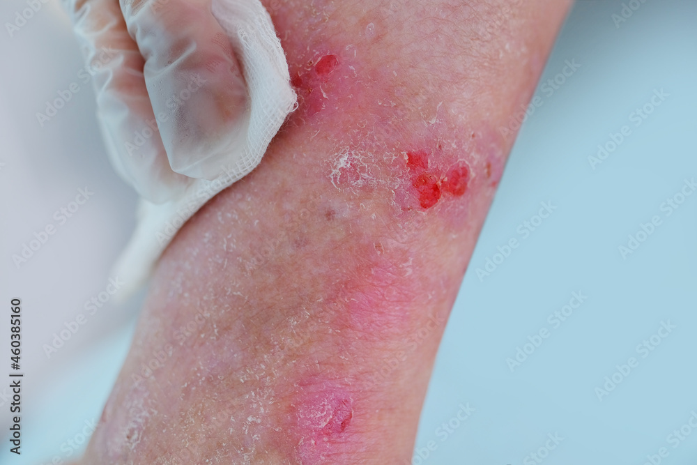 female doctor assistant examines and treats leg woman with scratches ...