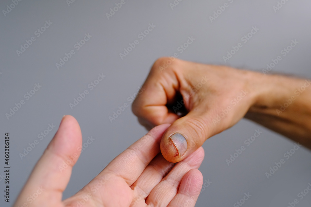 injured male hand close-up, thumb finger injury accident, bruise on ...