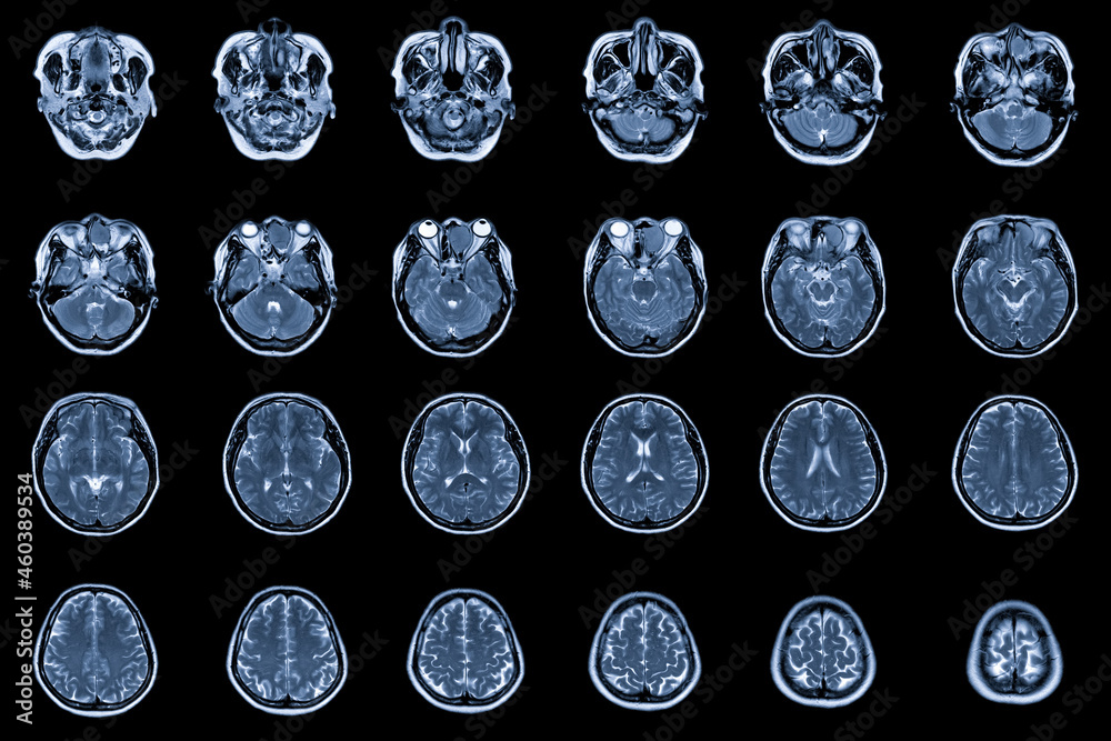 MRI Brain with and without contrast media Findings: There is a 3.5cm ...