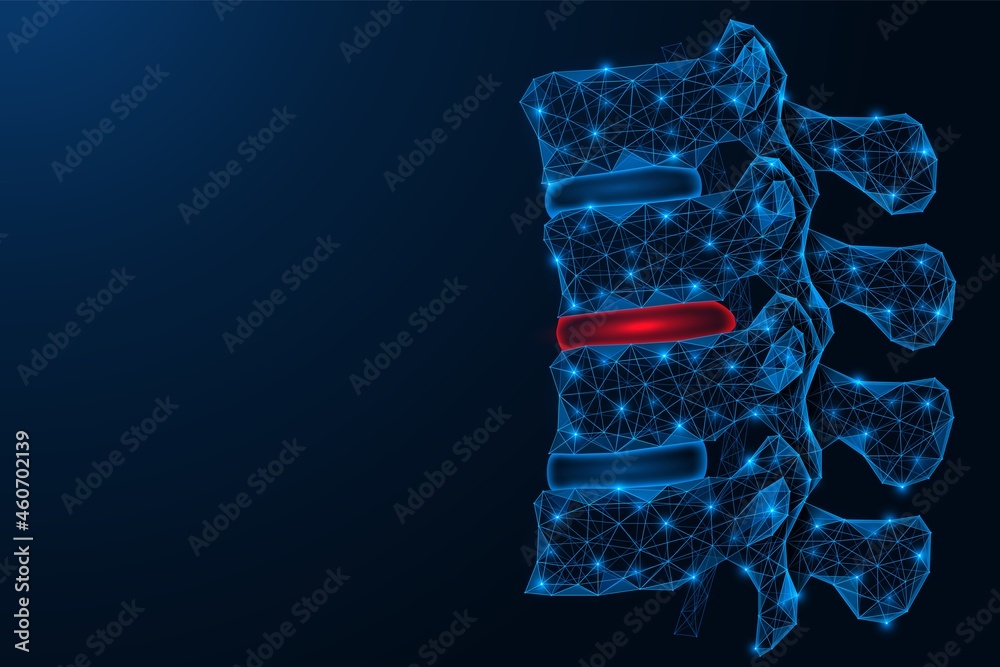 Inflamed intervertebral disc. Spinal vertebral hernia. A low-poly ...
