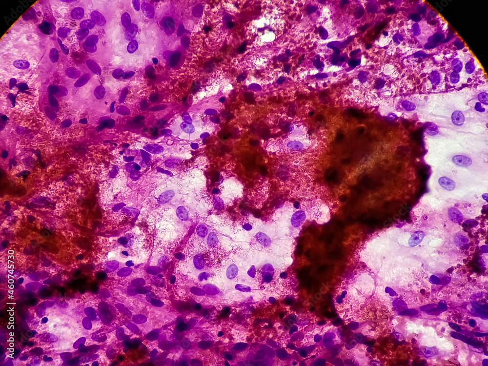 FNAC of lymph nodes tissue Cytology microscopic 100x show ...