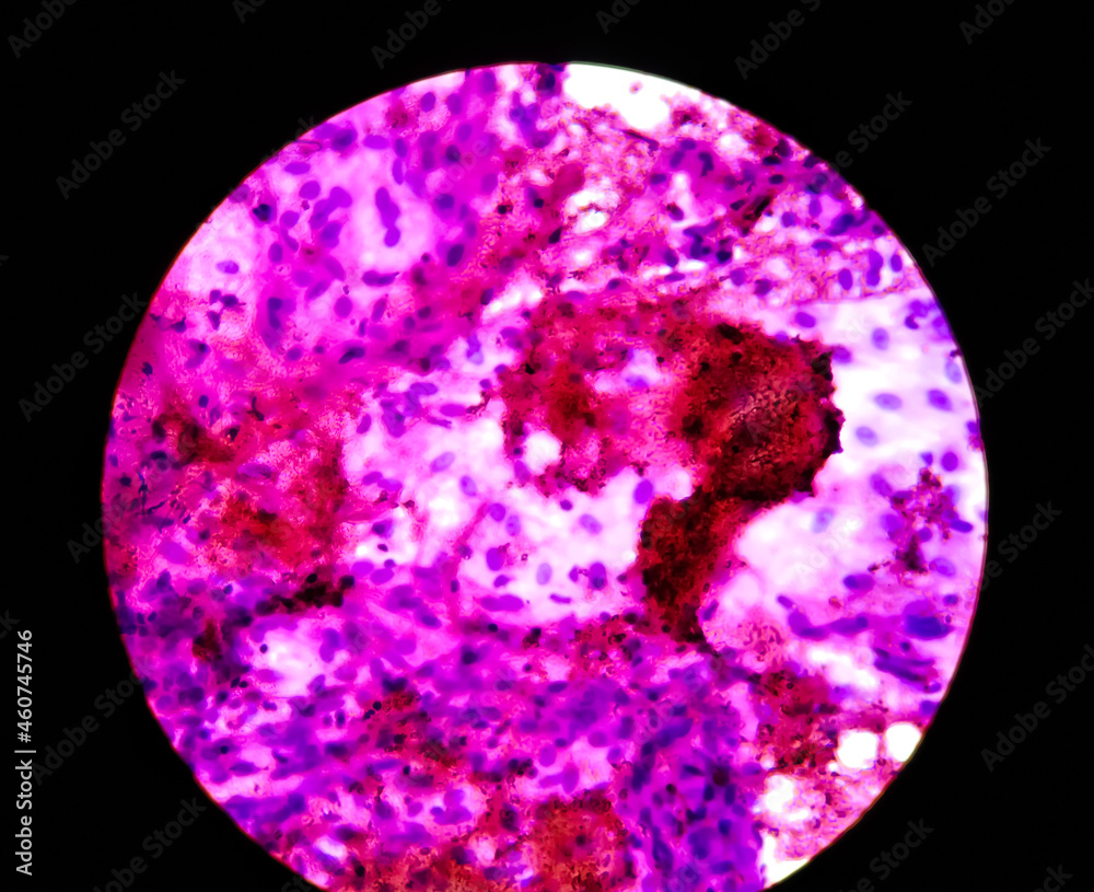 FNAC of lymph nodes tissue Cytology microscopic 100x show ...