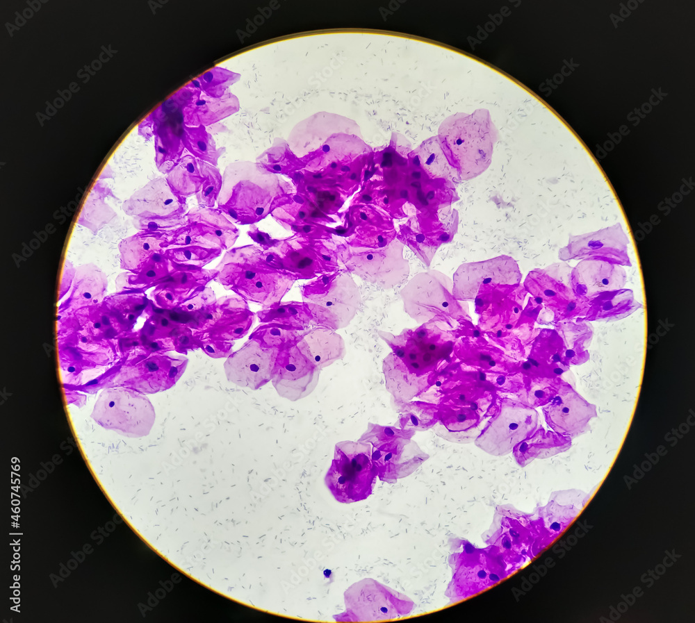 Pap's smear Cytology microscopic 100x show normal human cervix cells ...