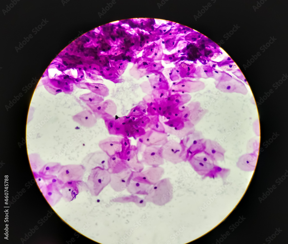 Microscopic view of normal human cervix cells. Squamous epithelial ...