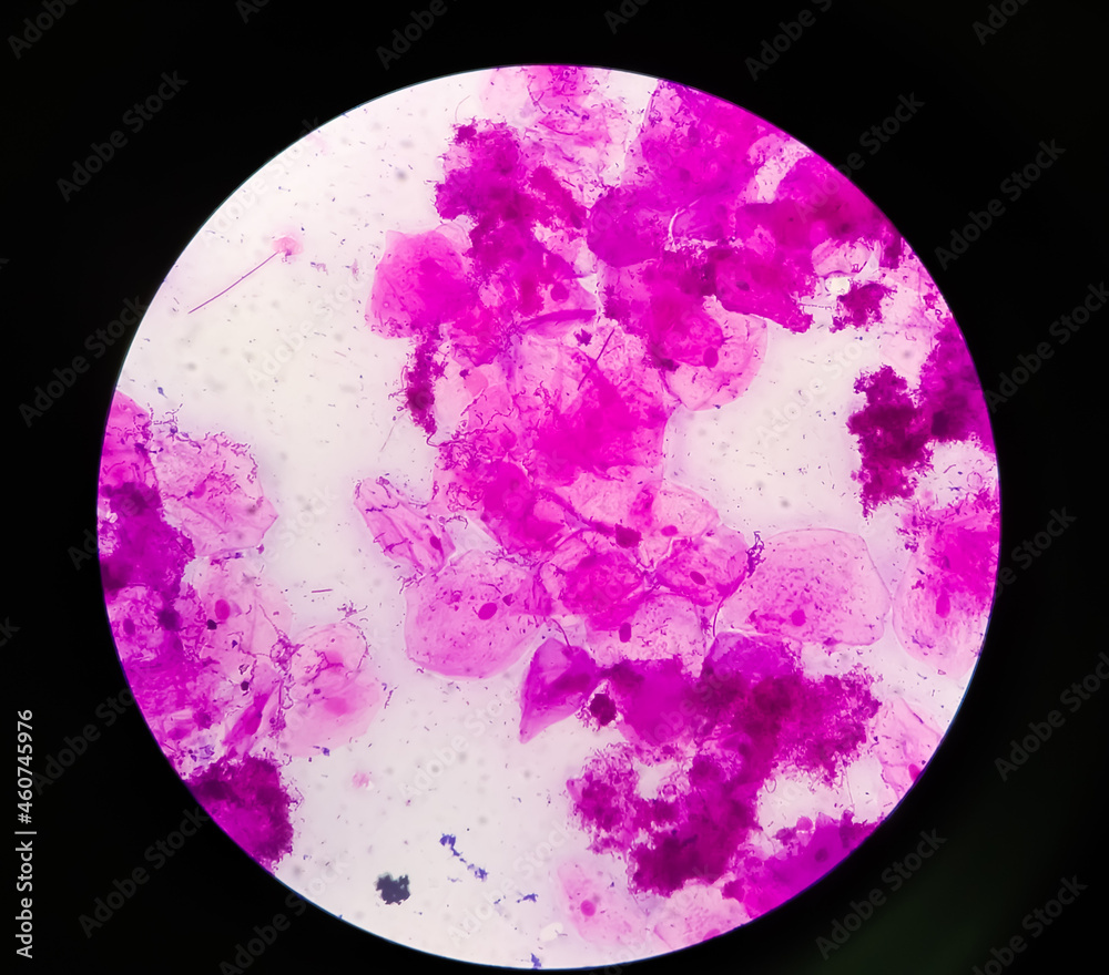 Microscopic Close View Of High Vaginal Swab Gram Stain Smear 40x