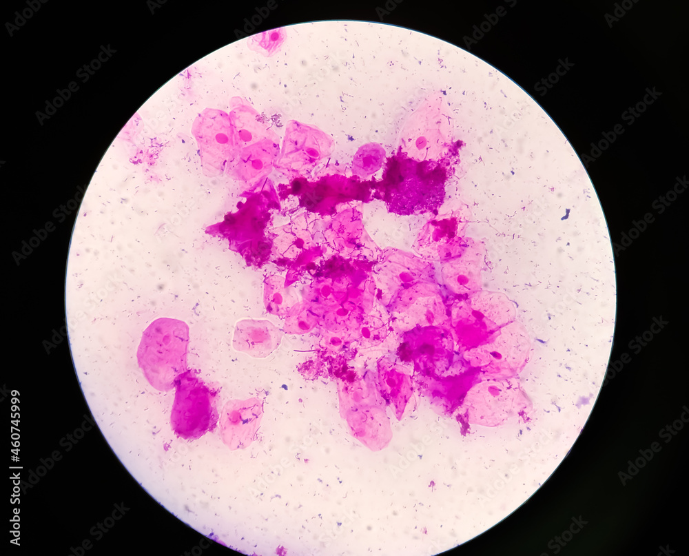 High Vaginal Swab Gram Stain Microscopic 100x Show Few Pus Cells And
