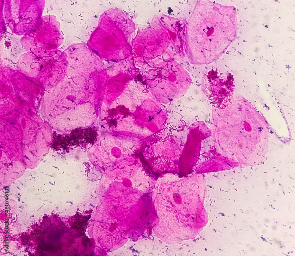 Bacterial Vaginosis Gram Stain