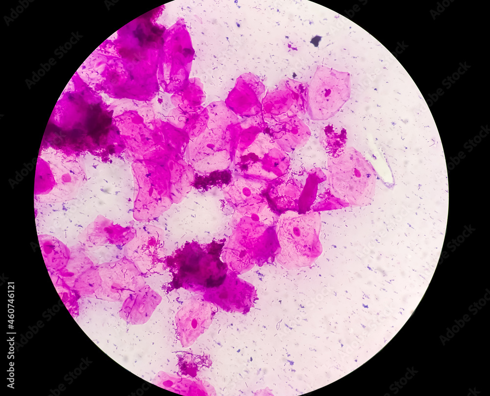 High vaginal swab gram stain microscopic 100x show few pus cells and ...