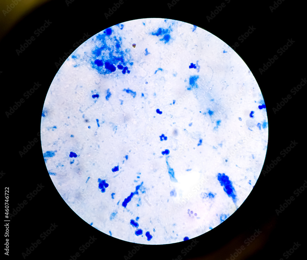 Pulmonary Tuberculosis ( TB ) : Sputum AFB stain microscopic image. To ... Pulmonary Tuberculosis ( TB ) : Sputum AFB stain microscopic image. To ...
