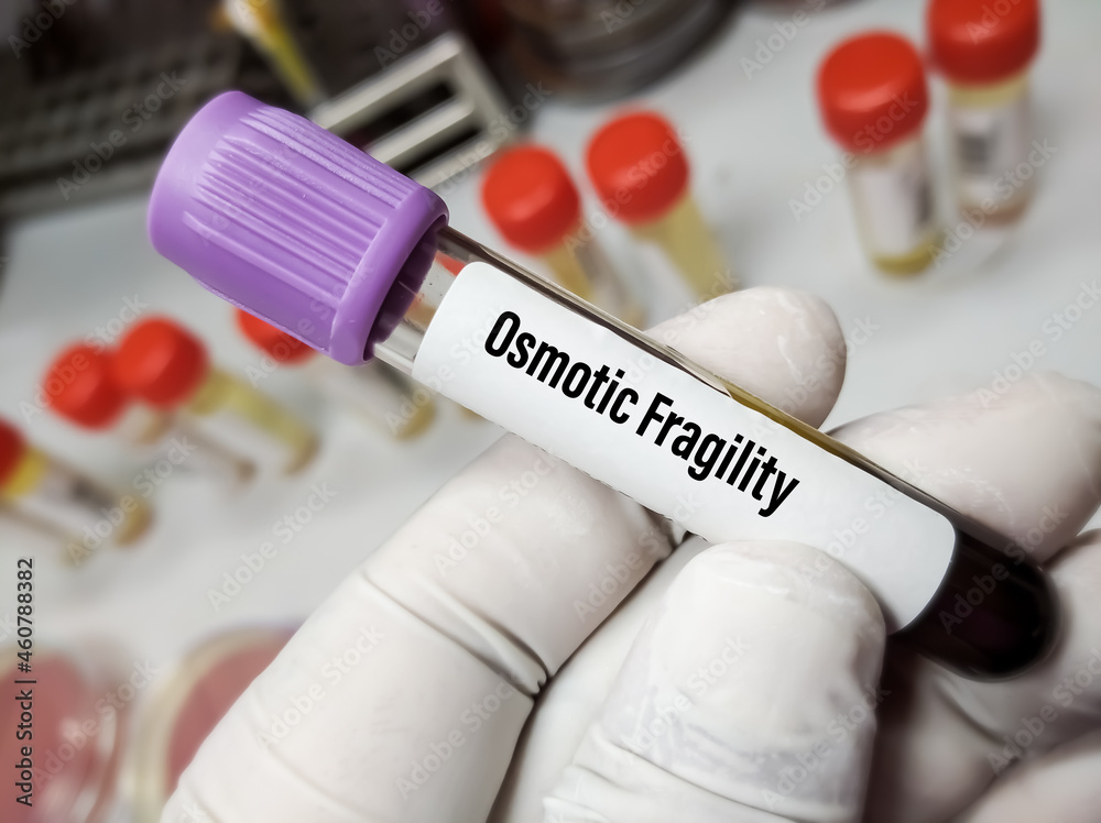 Blood sample for Osmotic Fragility(OF) test, thalassemia screening test ...