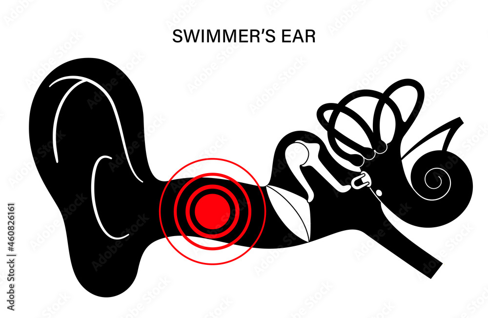 Swimmers ear otitis Stock Vector | Adobe Stock