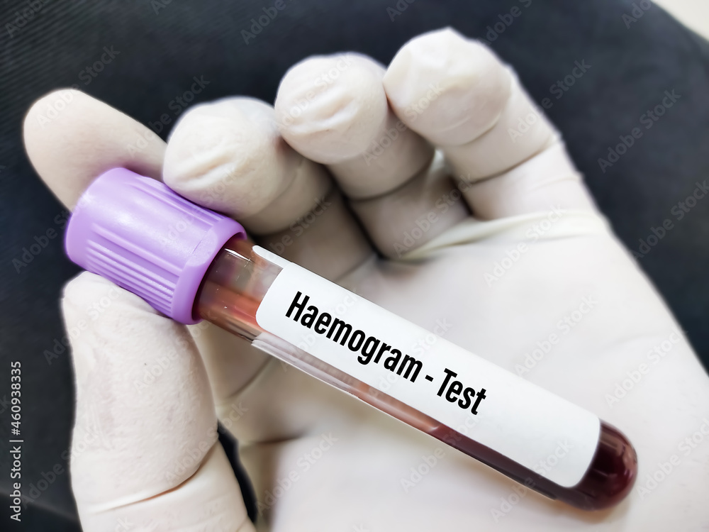 Blood sample tube for Haemogram or Complete Blood Cell (CBC) test foto ...