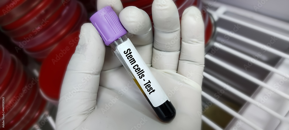 Blood sample tube for stem cells test, neurological or heart disease ...
