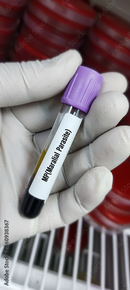 Blood sample tube for MP(malarial parasite) test, whole blood EDTA ...
