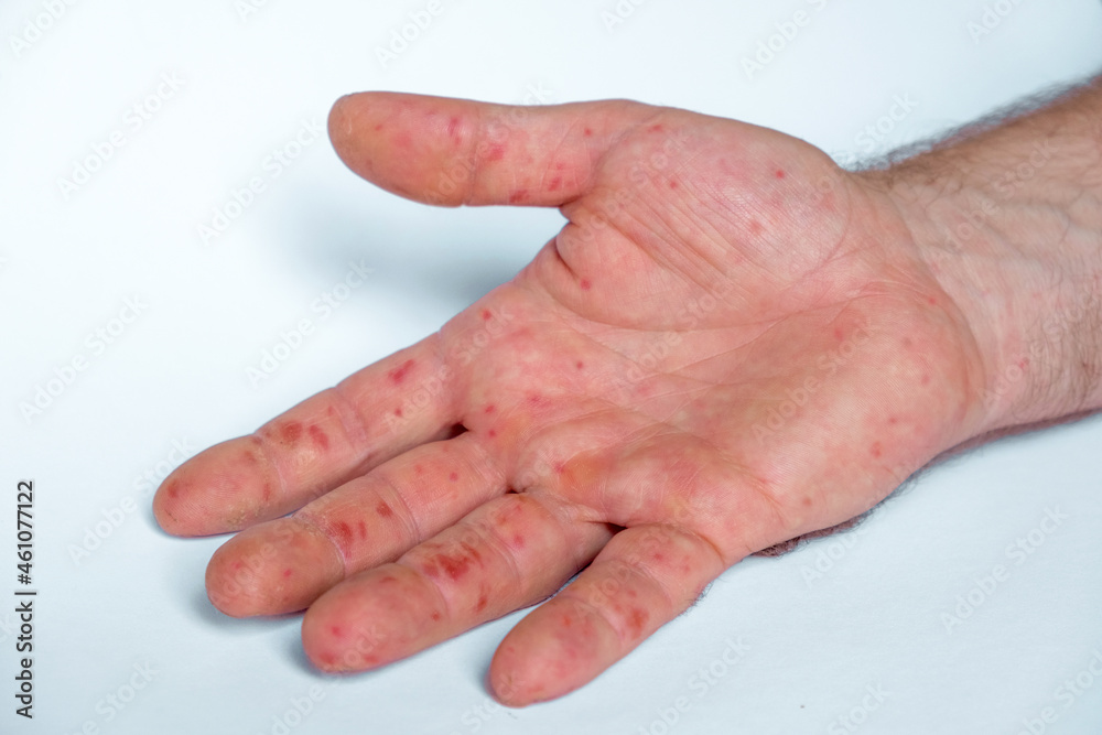 Painful rash, red spots blisters on the hand. Close up Allergy rash ...