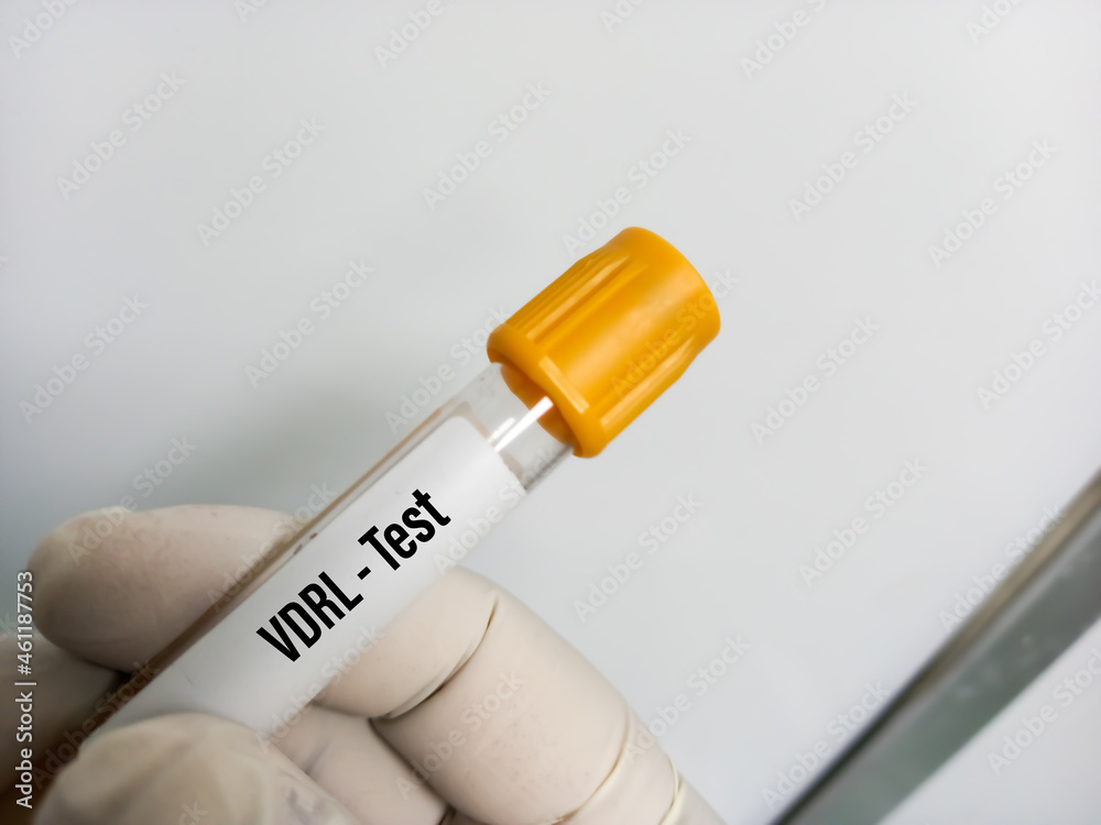 Blood samples for VDRL(venereal disease research laboratory) test in ...