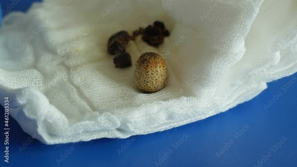 Removed gallstones on compress after gallbladder laparoscopic surgery ...