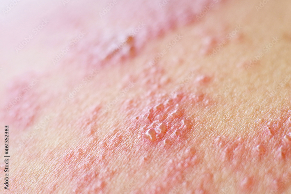 Skin diseases caused by viral infections,shingles Stock Photo | Adobe Stock