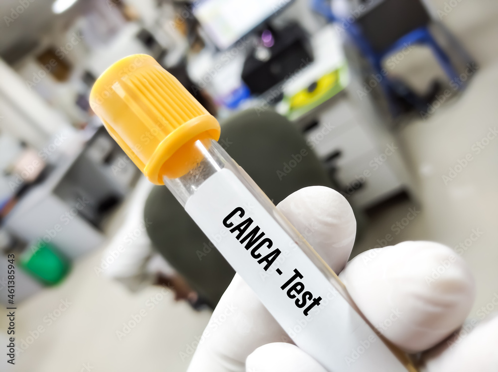 Lab Technologist holds Blood samples for cANCA (Anti-neutrophil ...