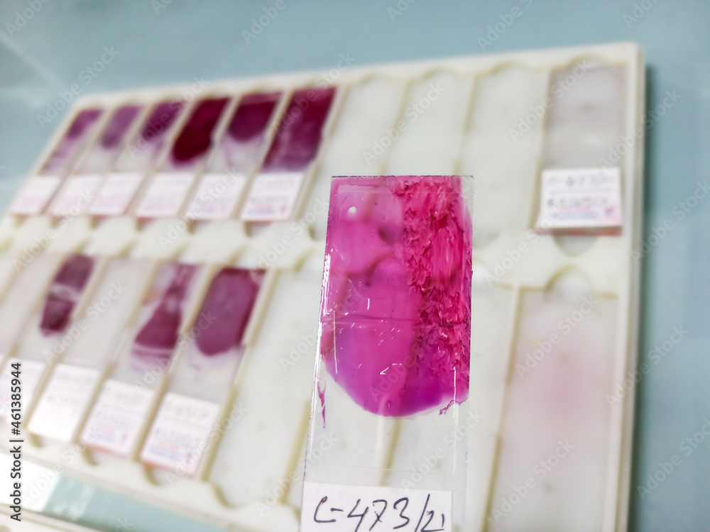 Close view of Cytopathology slides stained with Pap's stain, displayed ...