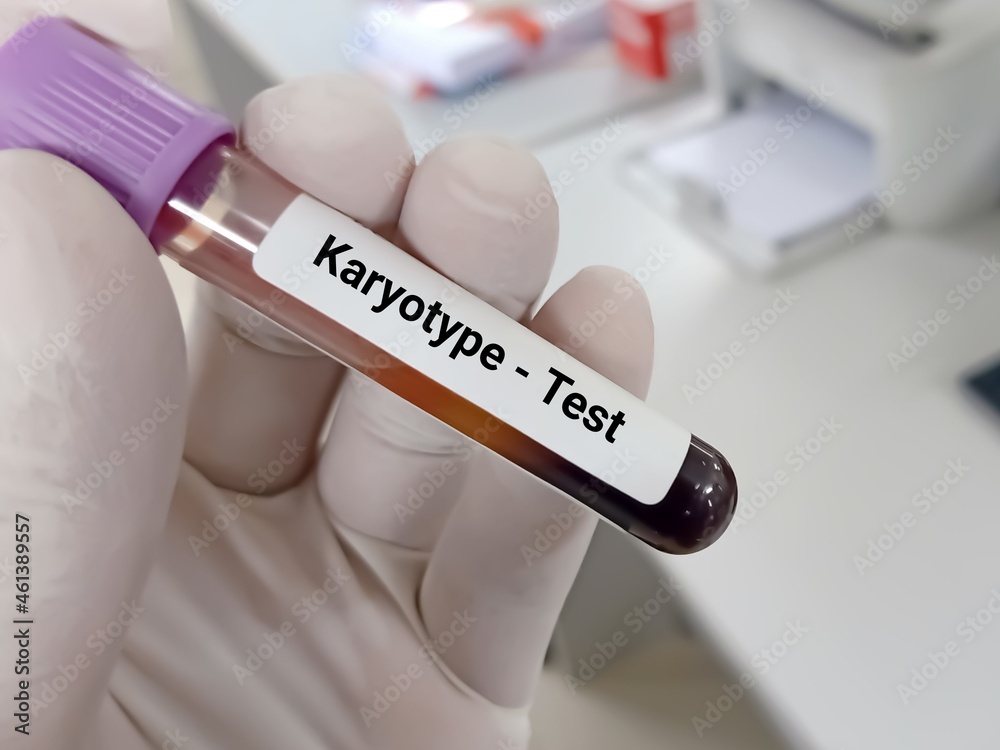 Biochemist or doctor holds blood sample for karyotype test, abnormal ...