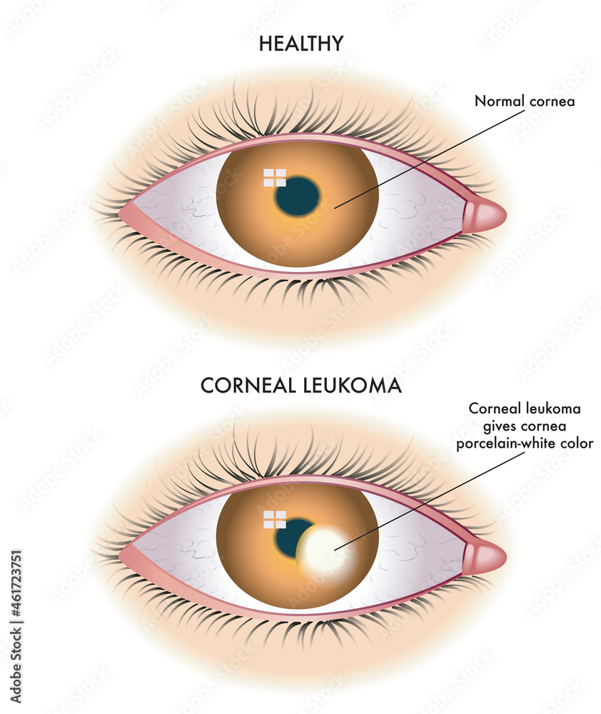 Medical illustration shows the comparison between a normal eye and one ...
