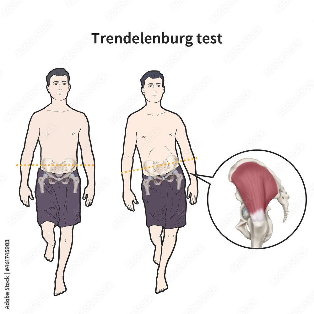 Trendelenburg test 검사. 중둔근 검사 Stock Illustration | Adobe Stock
