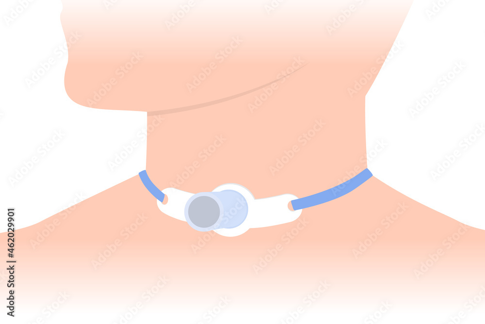 Tracheostomy tube at the patient neck who can not breathe with nose and ...