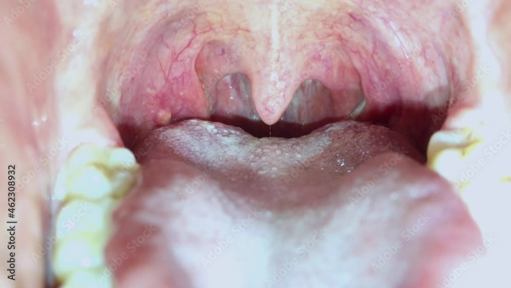 Close up to the inside of the human mouth. ENT medicine. Angina ...