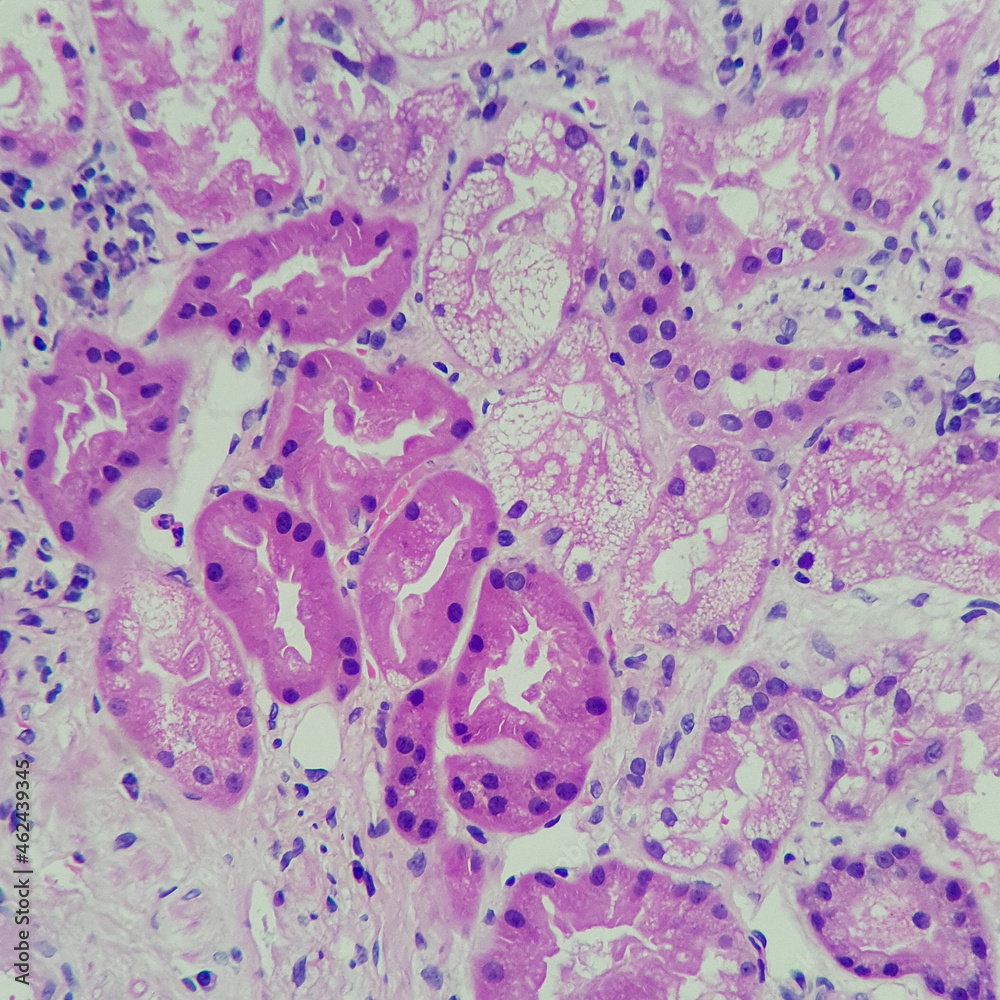 Camera photo of acute tubular injury showing cytoplasmic vacuolization ...