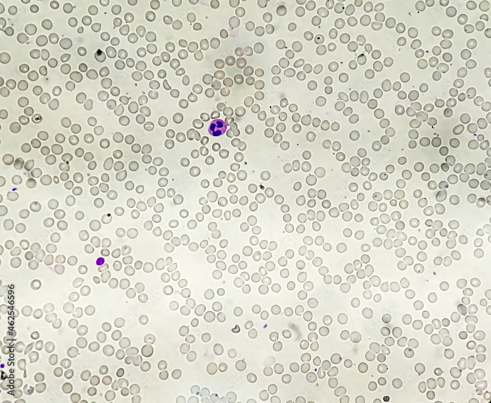Acute leucopenia and thrombocytopenia. close up micrograph Stock Photo ...