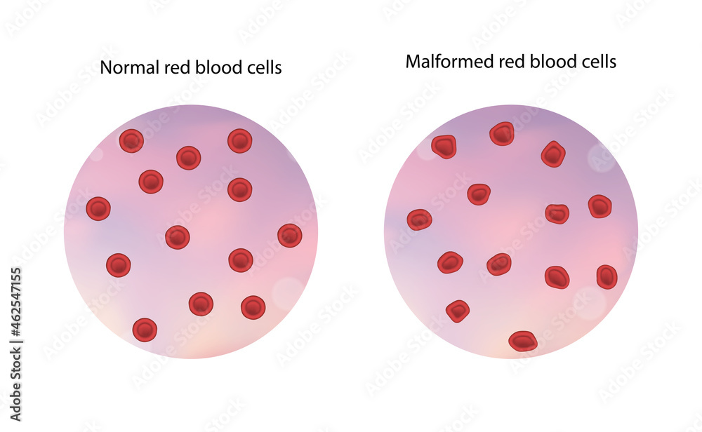 Thalassemia. Abnormally malformed shaped red blood cells. Vector ...