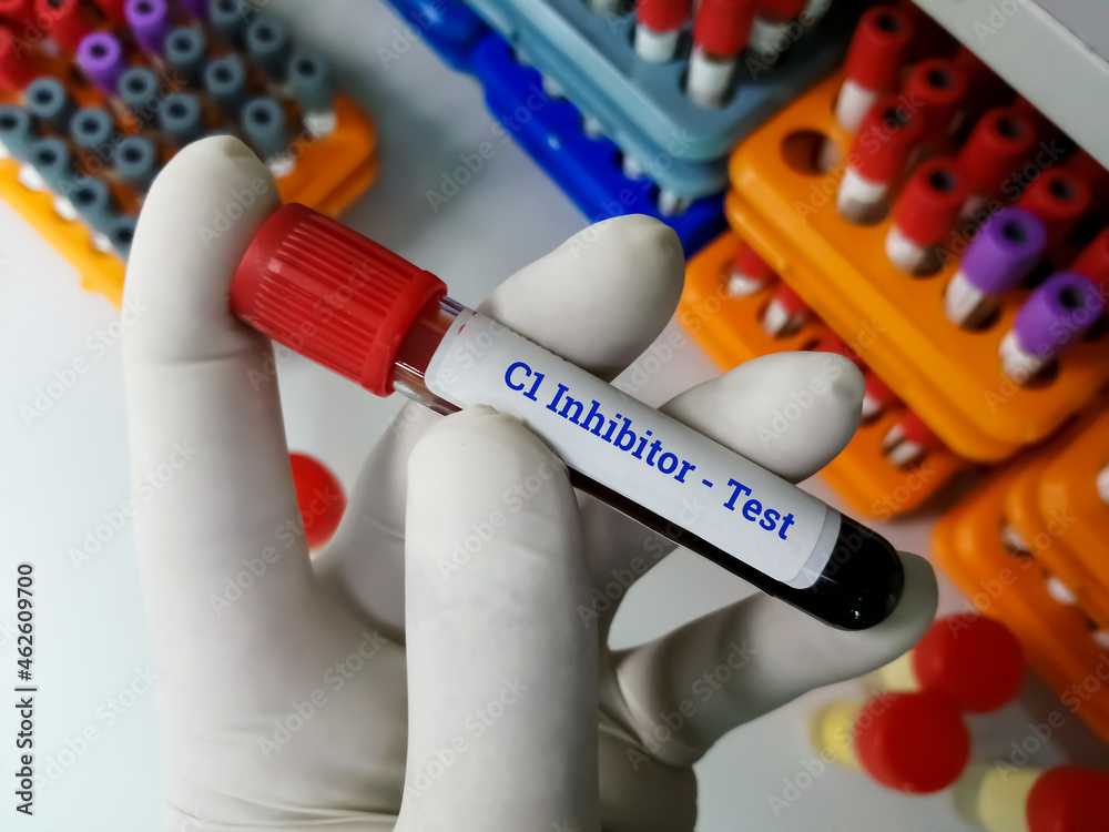 Scientist hold blood sample for C1 Inhibitor test, diagnosis for ...