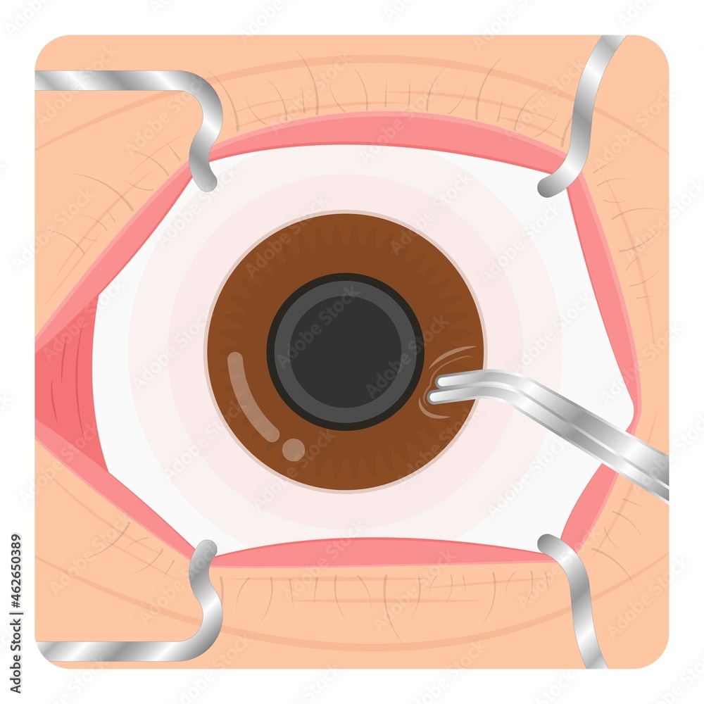 Eye floaters fluid vision retina myopia trauma surgery loss of light ...