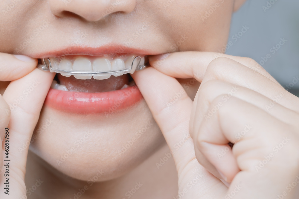 A woman is wearing a retainer on her teeth. Stock Photo | Adobe Stock