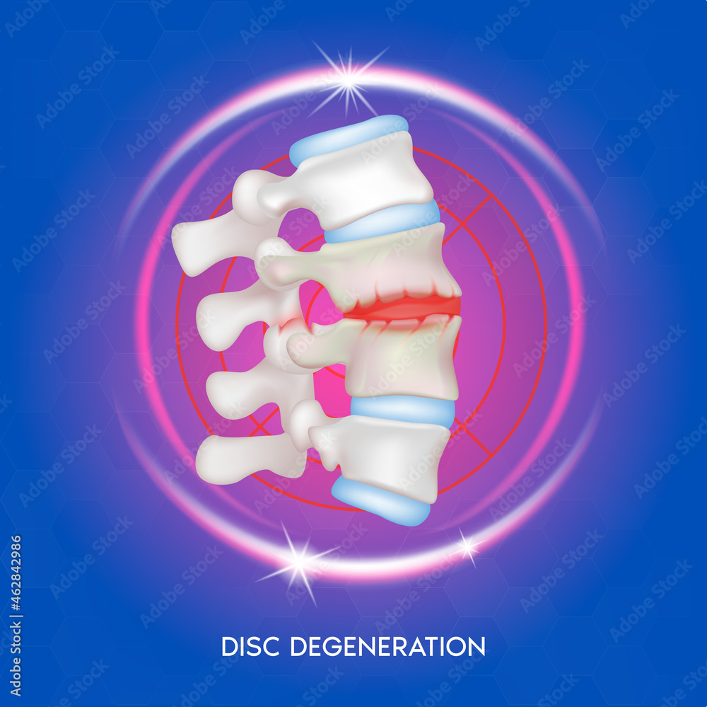Disc degeneration spine diseases. Intervertebral discs and bones. Human ...