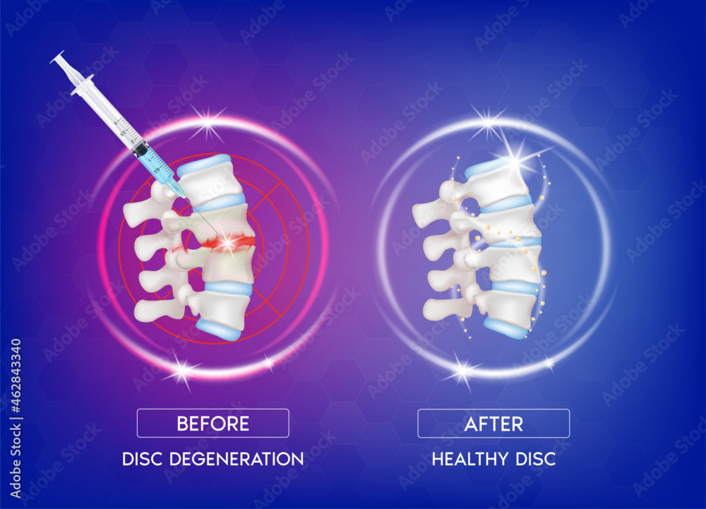 Before and after spinal treatment with syringe needle to degenerative ...
