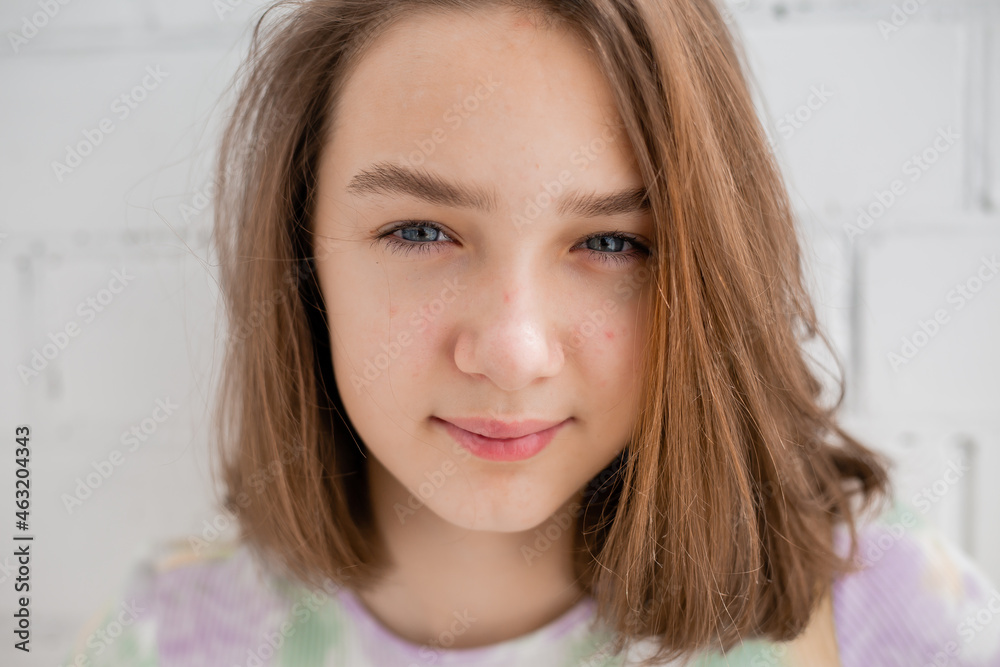Face of a teenage girl in close up. Teen with problematic skin. Girl ...