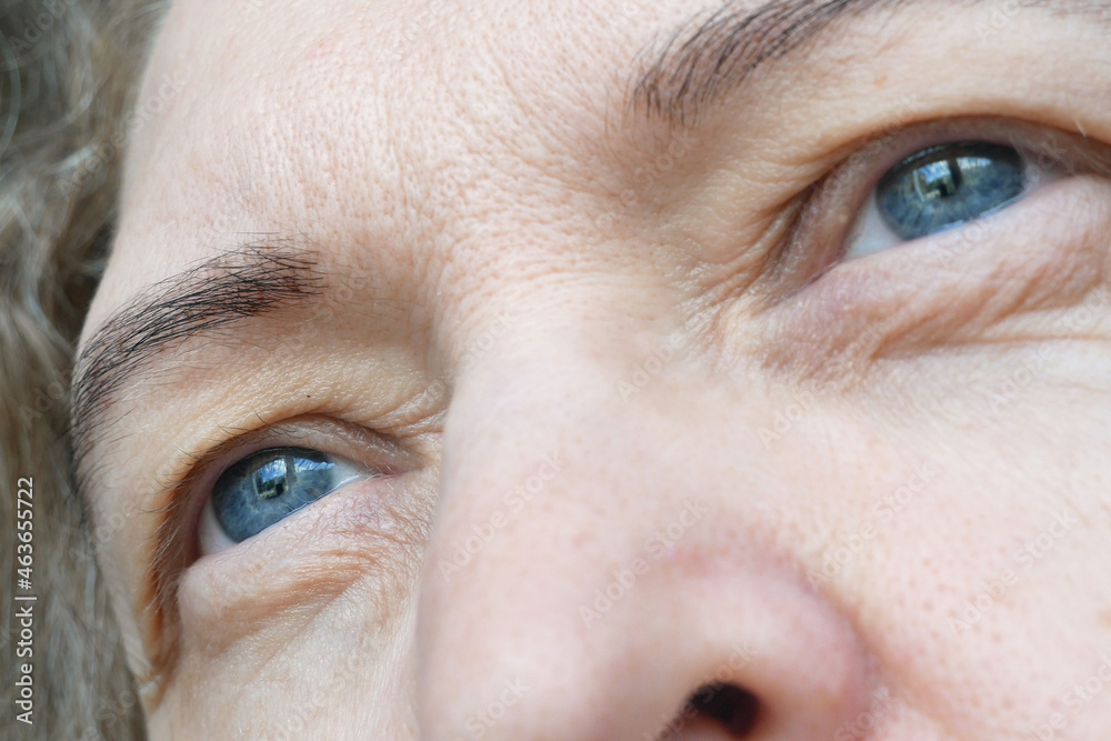 middle aged female's eye with drooping eyelid. Ptosis is a drooping of ...