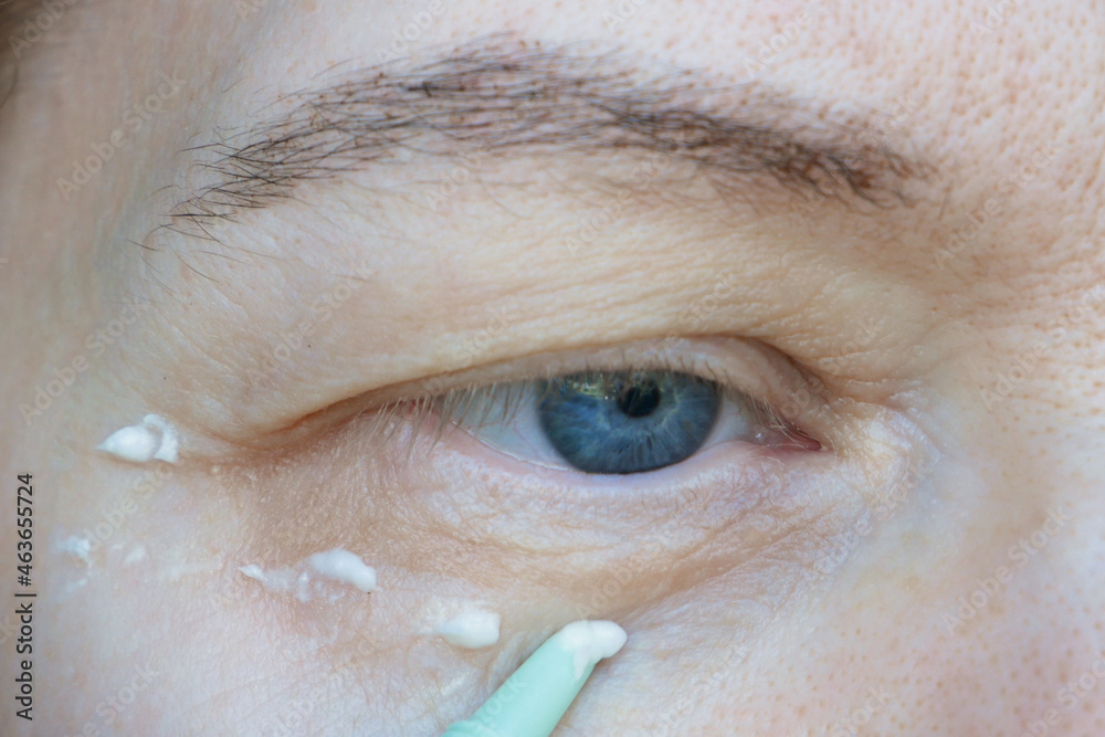 middle aged female's eye with drooping eyelid. Ptosis is a drooping of ...