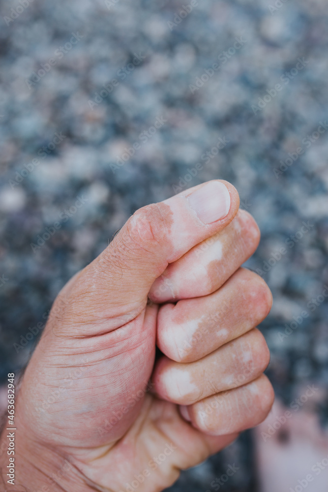 Disorder of skin pigmentation - white age spots on the fingers of a ...