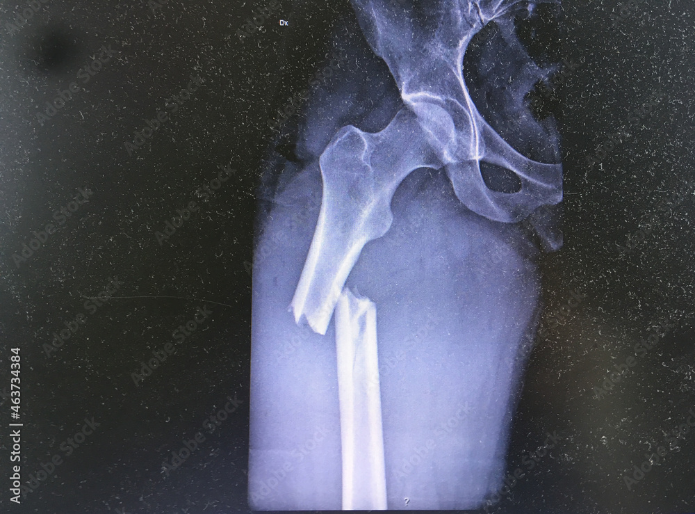 X-Ray of broken Femur Bone Stock Photo | Adobe Stock
