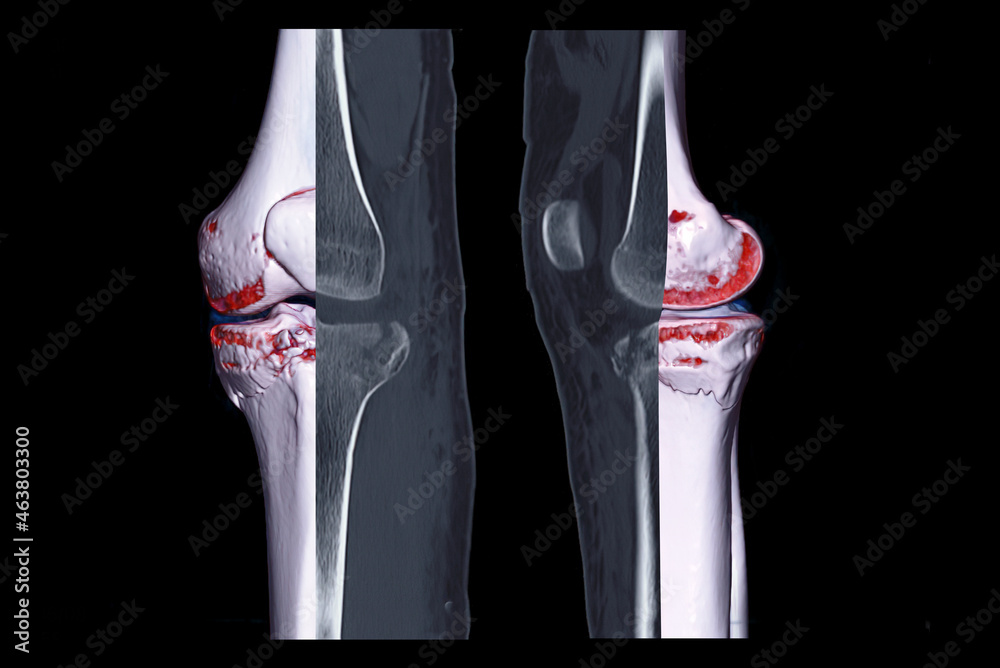 Compare of CT knee joint 3D rendering image and CT knee sagittal view ...