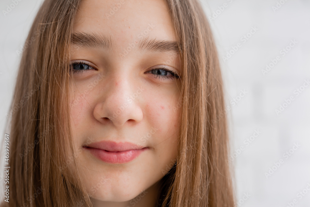 Face of a teenage girl in close up. Teen with problematic skin. Girl ...