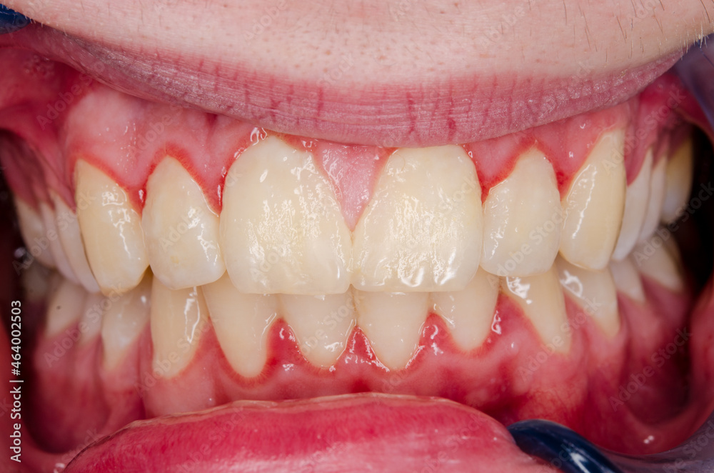 Poster gingivitis and dental plaque, upper incisors – Wall Art | UkPosters