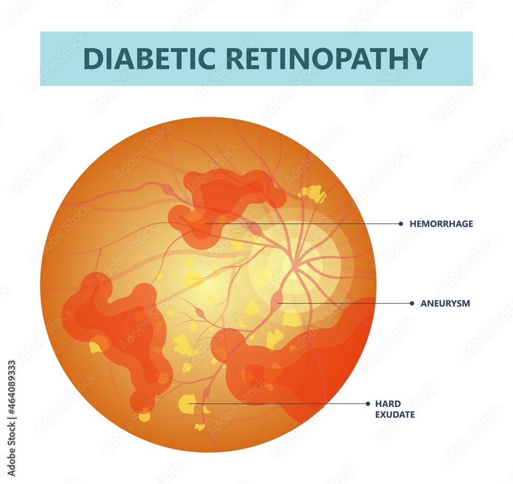 Diabetic retinopathy fundus age eye blood vessels vision Blurred loss ...